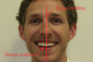 Digital Smile Design | Alexandria | Kenneth M. Van Stralen, DDS